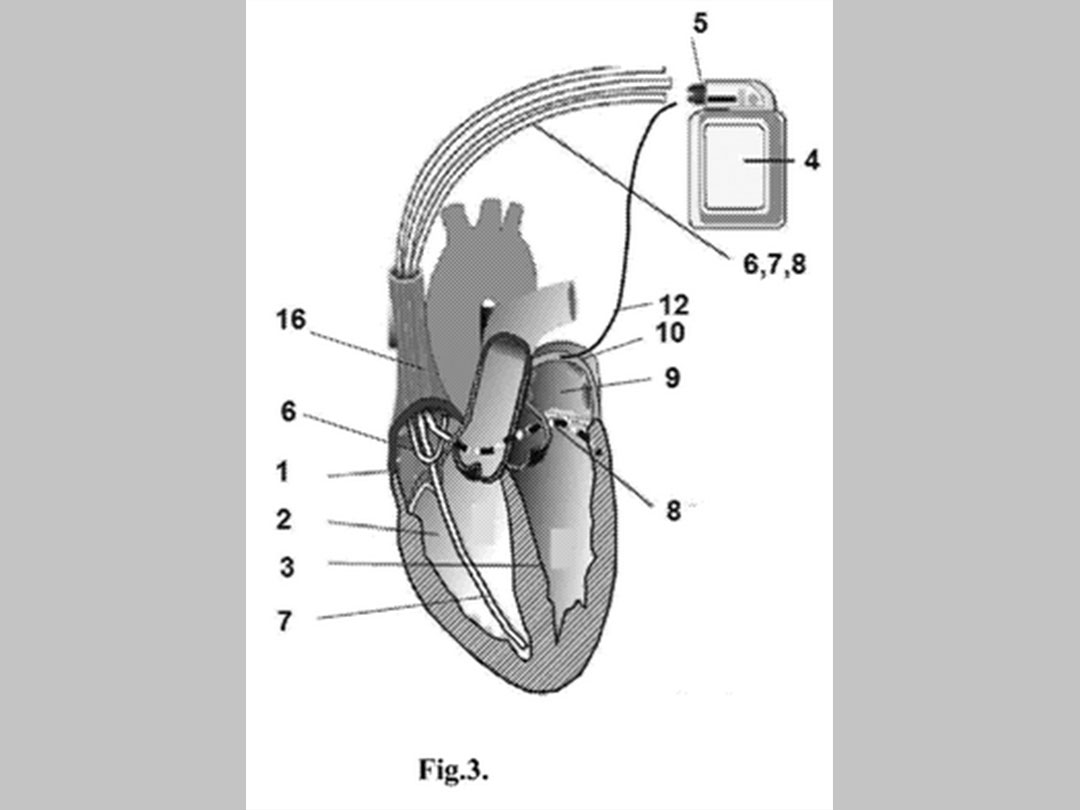 Apparatus for recovering and stabilizing normal heart rate of patients ...